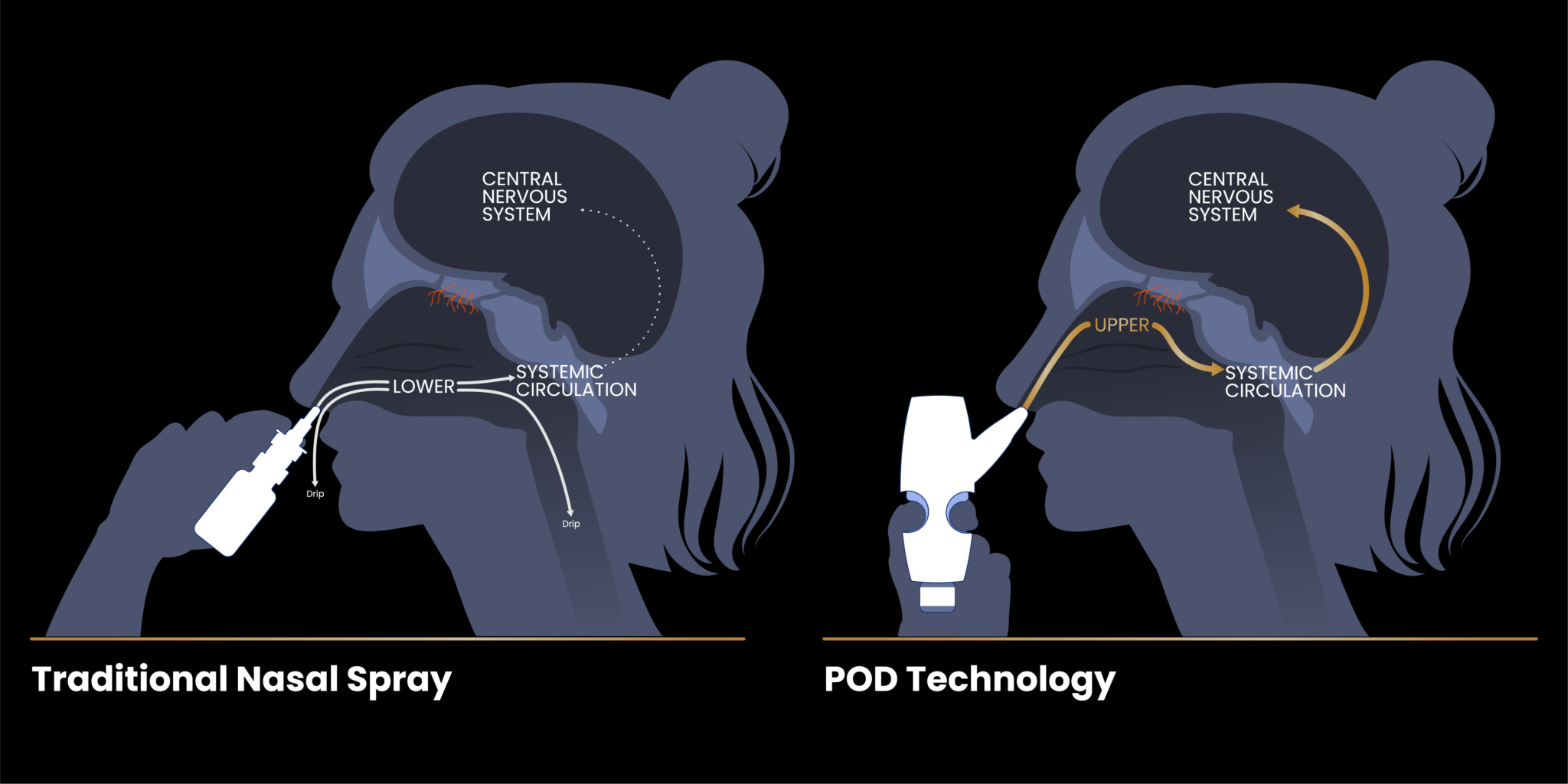Trudhesa DHE Nasal Spray: Top 7 Reasons to Consider DHE for Migraine ...