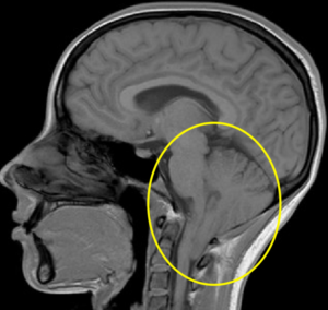 Understanding Chiari Malformation Headache Symptoms and Effective ...