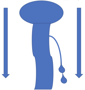 CSF Leak Symptoms, Causes, Testing, and Treatments - Virtual Headache ...