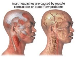 16 Simple & Effective Techniques for Tension Headache Relief