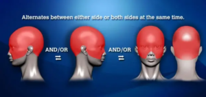 Location of Headache Meaning and Headache Placement Meanings on ...