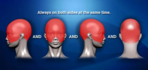 Location of Headache Meaning and Headache Placement Meanings on ...