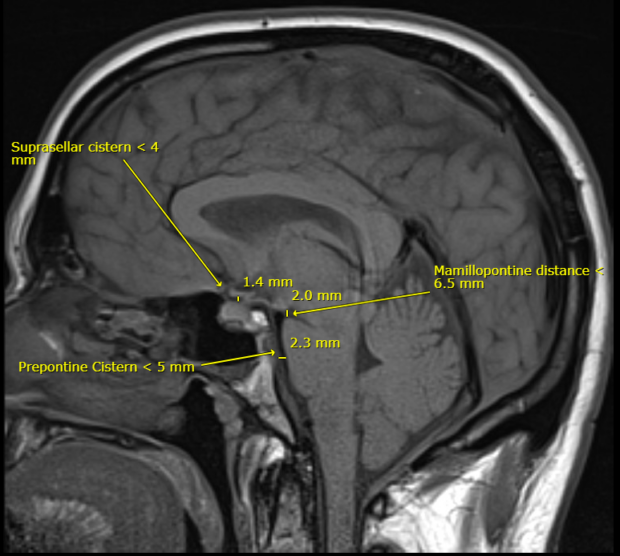 CSF Leak Symptoms, Causes, Testing, and Treatments - Virtual Headache ...